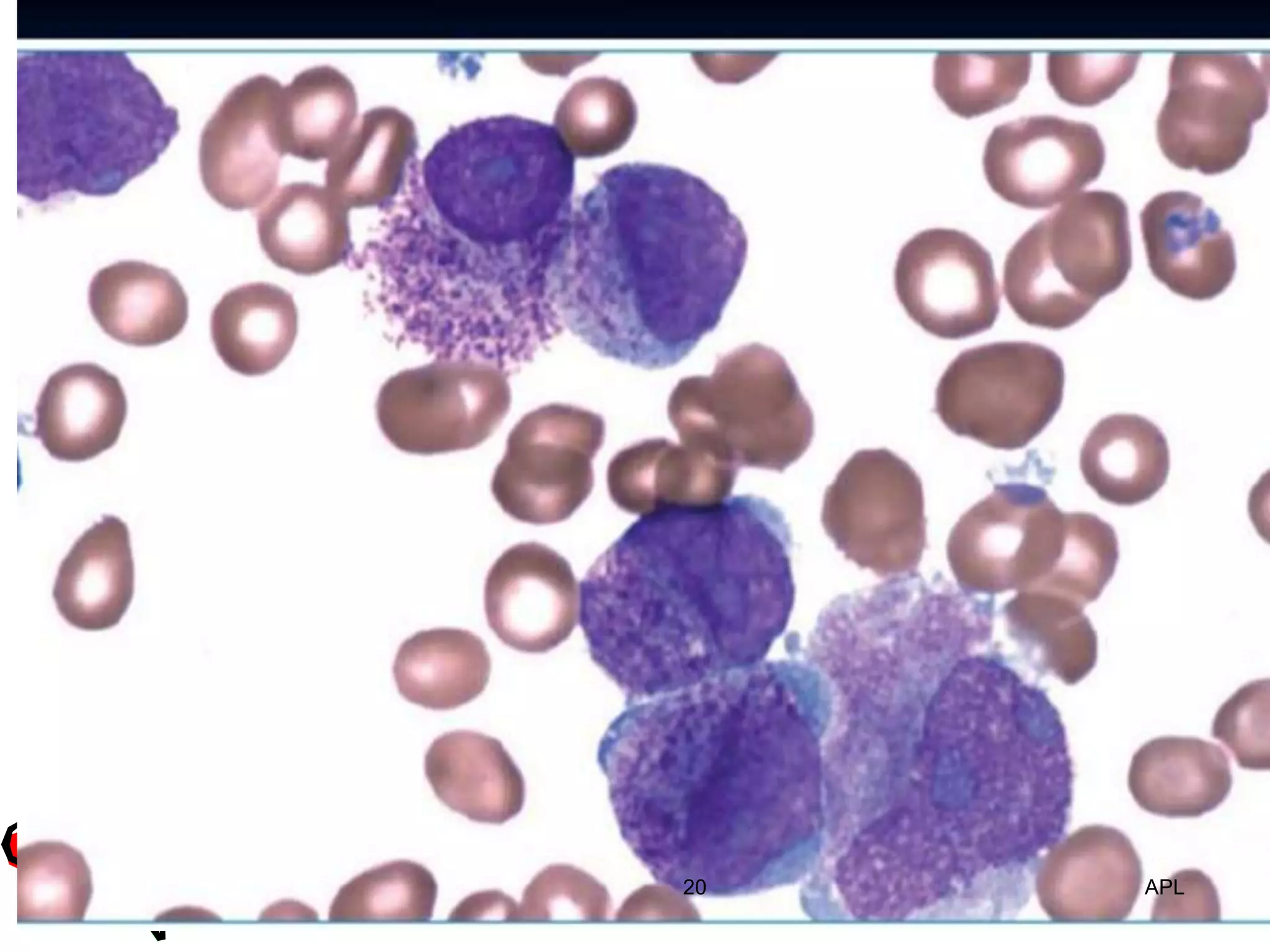 Acute Promyelocytic Leukaemia | PPTX