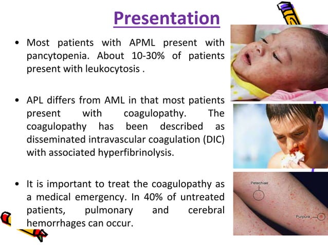 Acute Promyelocytic Leukaemia | PPTX | Blood Disorders | Diseases and ...