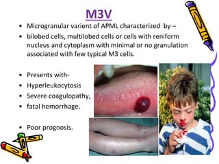Acute Promyelocytic Leukaemia | PPTX