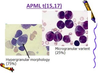 Acute Promyelocytic Leukemia Microgranular Variant