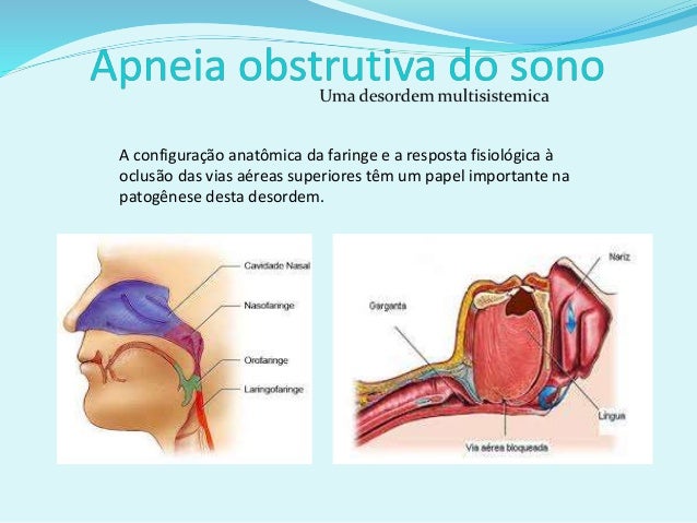 Apneia obstrutiva do sono