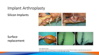 PIPJ Post-traumatic Arthritis: Arthrodesis vs Arthroplasty | PDF