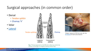 PIPJ Post-traumatic Arthritis: Arthrodesis vs Arthroplasty | PDF