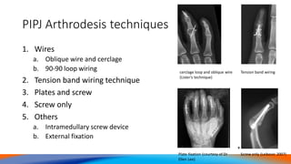 PIPJ Post-traumatic Arthritis: Arthrodesis vs Arthroplasty | PDF