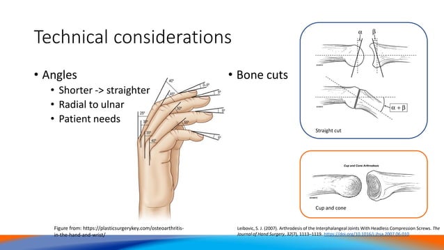 PIPJ Post-traumatic Arthritis: Arthrodesis vs Arthroplasty | PPT