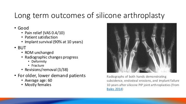 PIPJ Post-traumatic Arthritis: Arthrodesis vs Arthroplasty