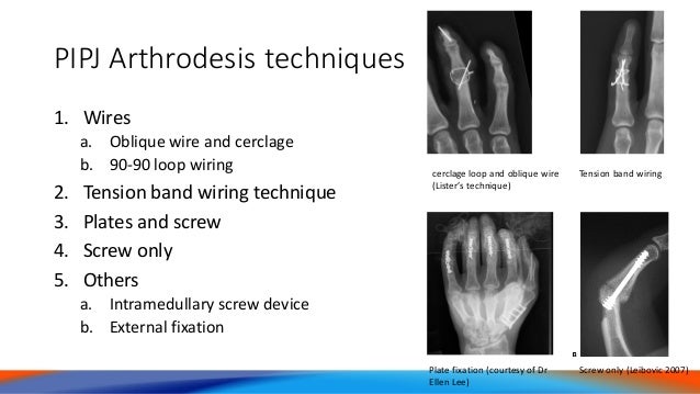 PIPJ Post-traumatic Arthritis: Arthrodesis vs Arthroplasty