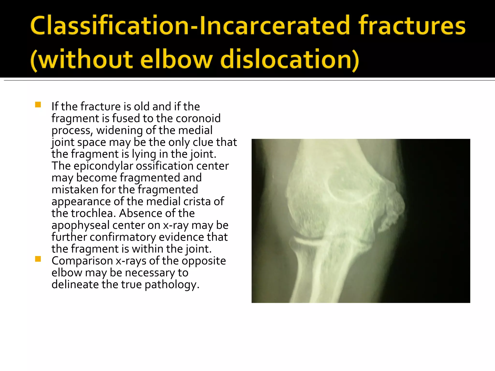Apophyseal injuries of elbow , medial epicondyle avulsion fractures ...