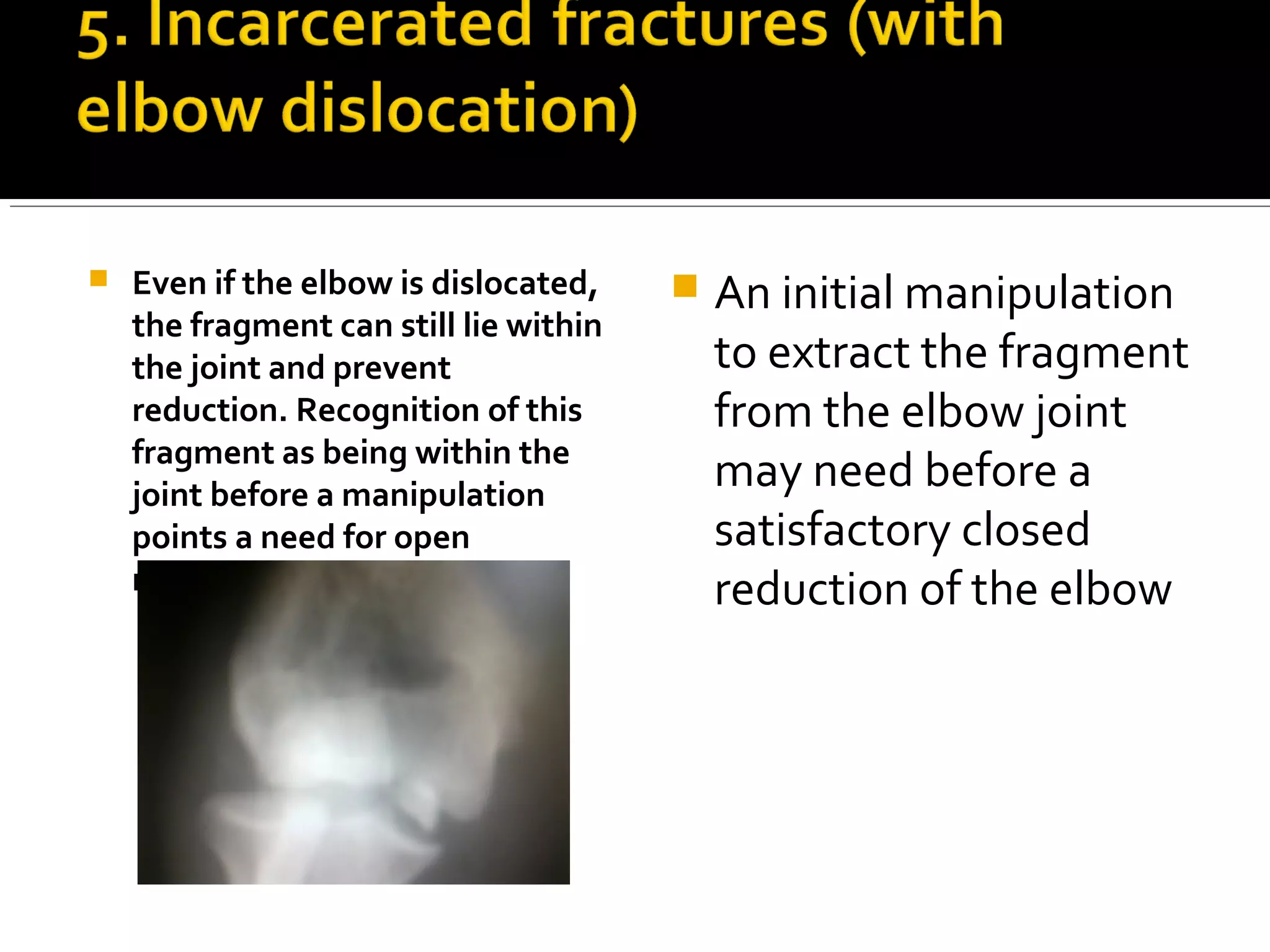 Apophyseal injuries of elbow , medial epicondyle avulsion fractures ...