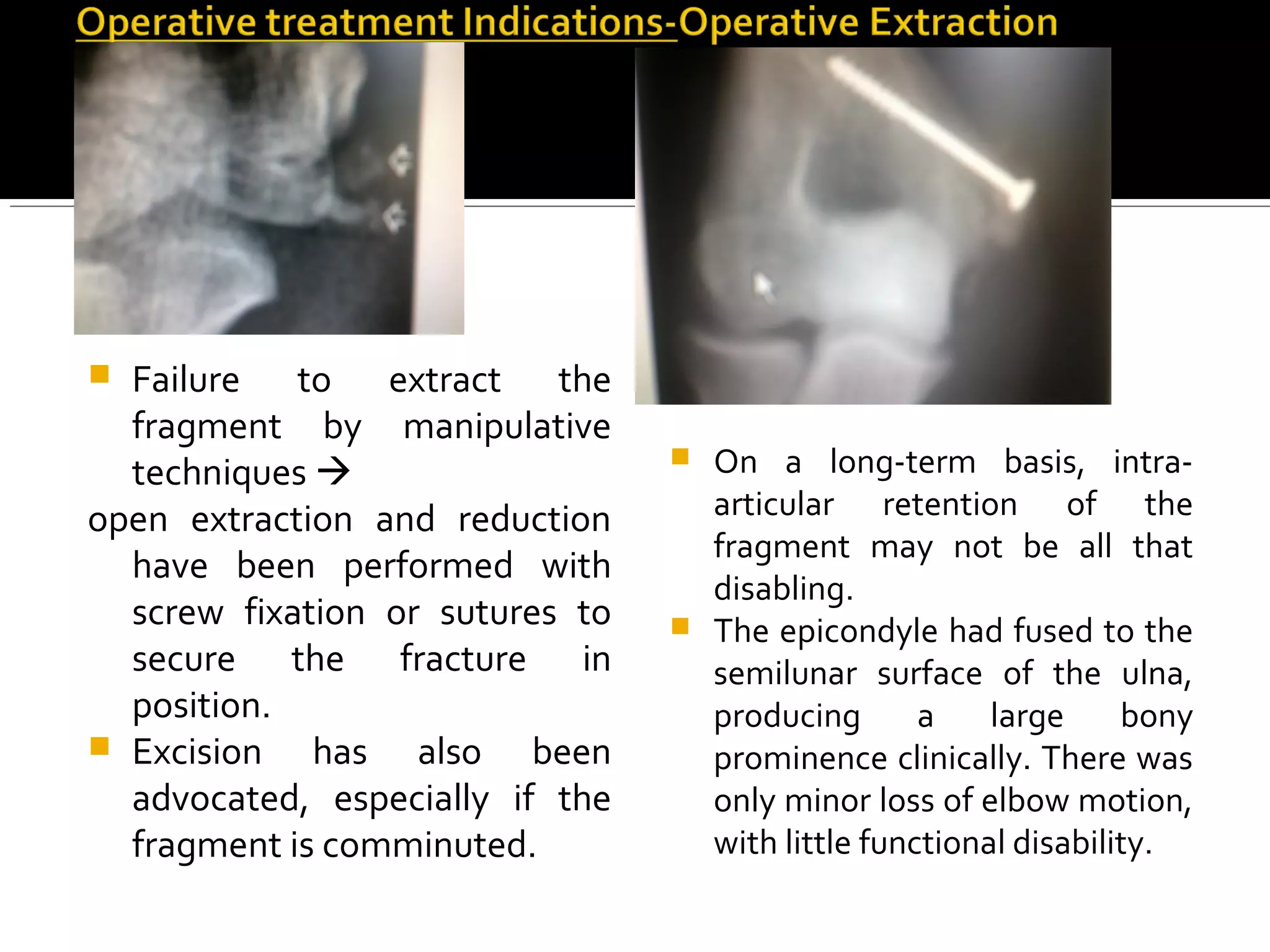 Apophyseal injuries of elbow , medial epicondyle avulsion fractures ...