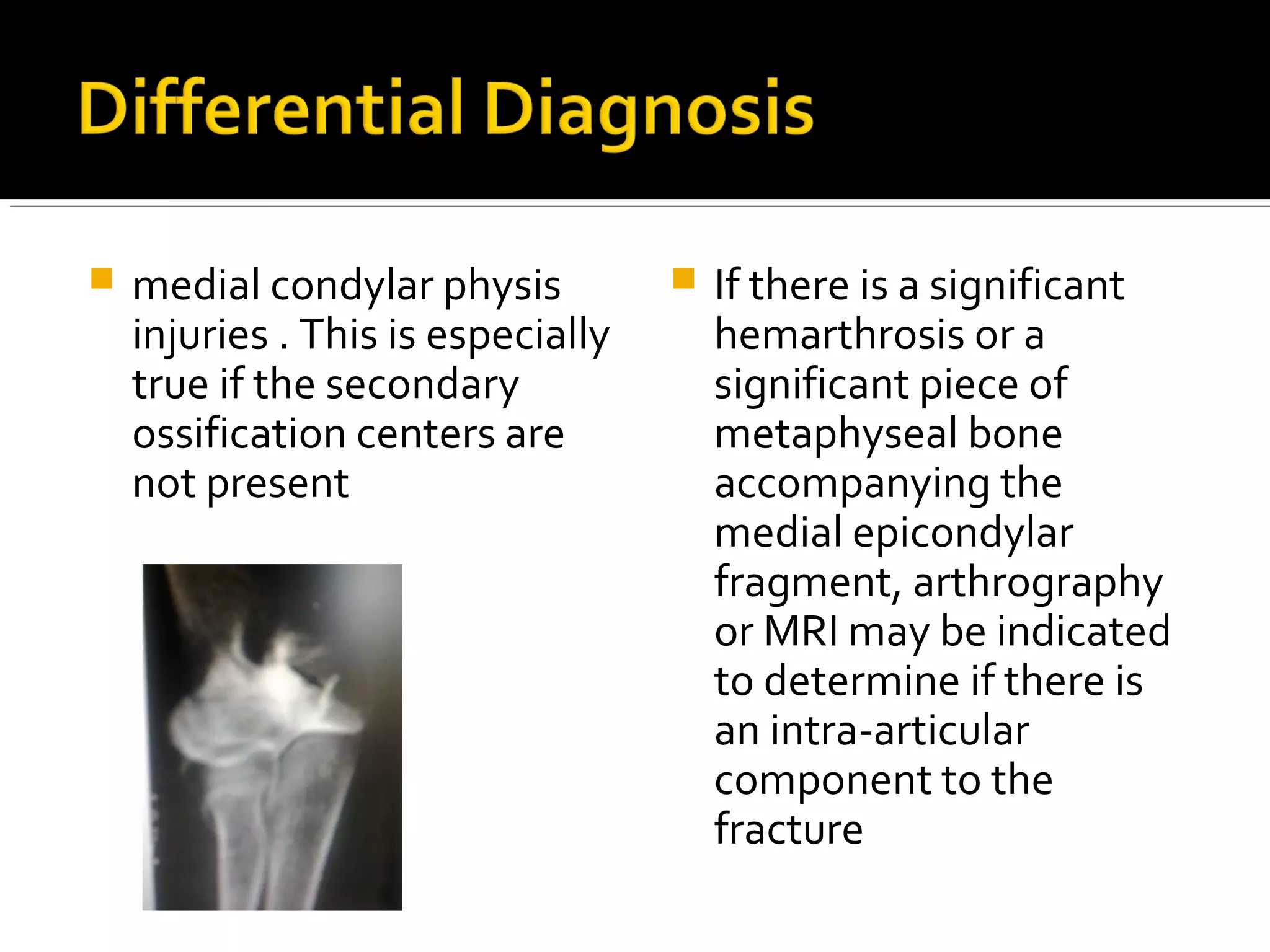 Apophyseal Injuries Of Elbow Medial Epicondyle Avulsion Fractures Ppt