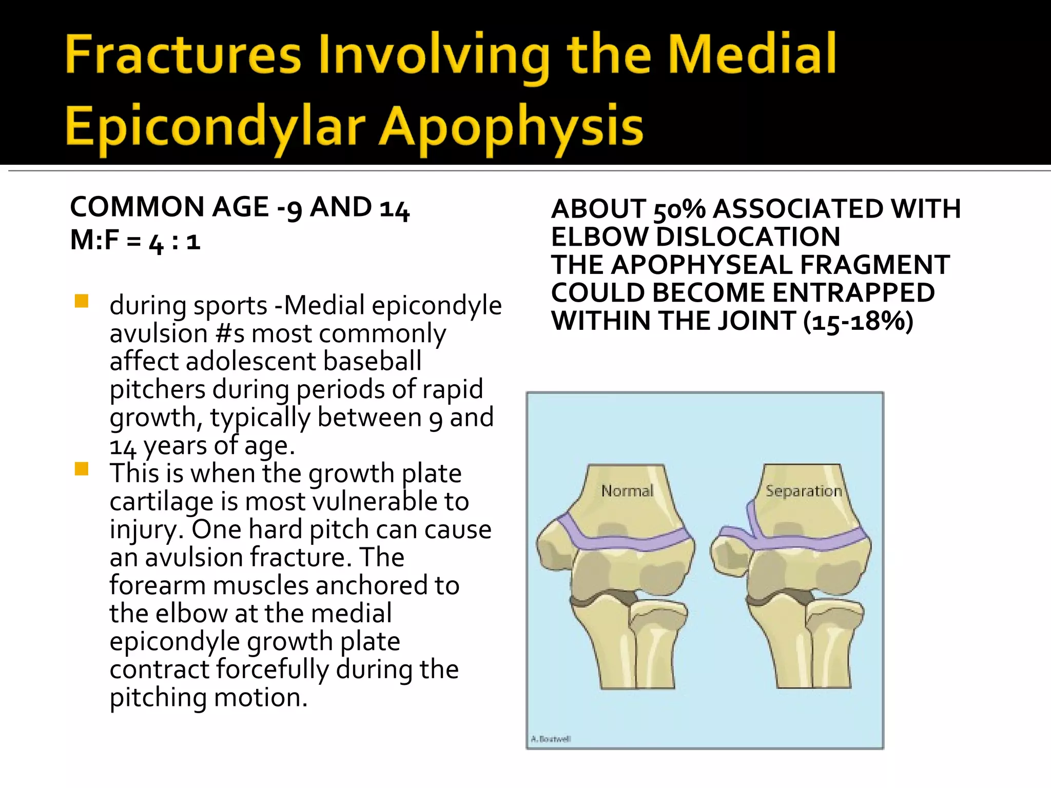 Apophyseal injuries of elbow , medial epicondyle avulsion fractures ...