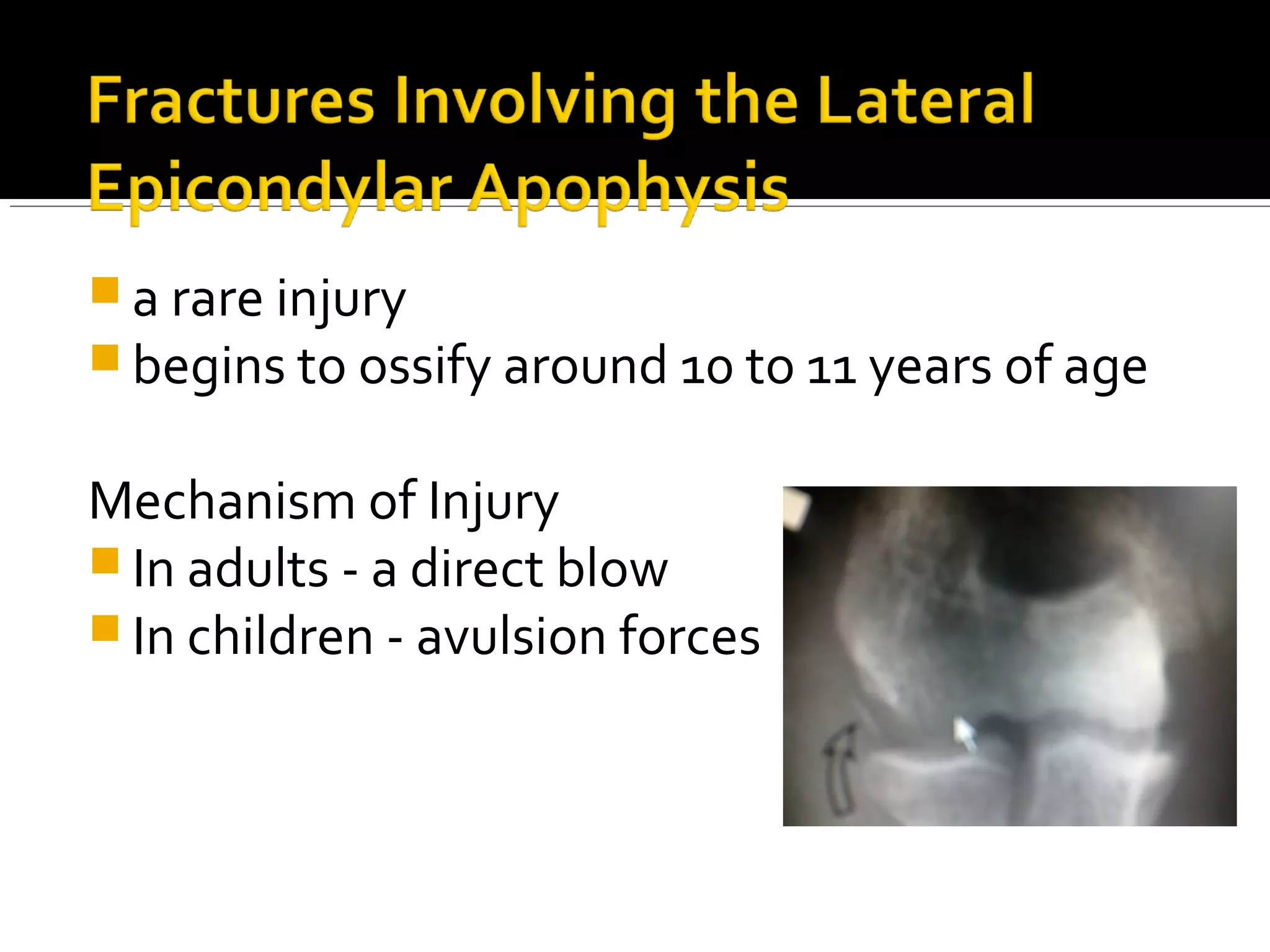 Apophyseal injuries of elbow , medial epicondyle avulsion fractures ...