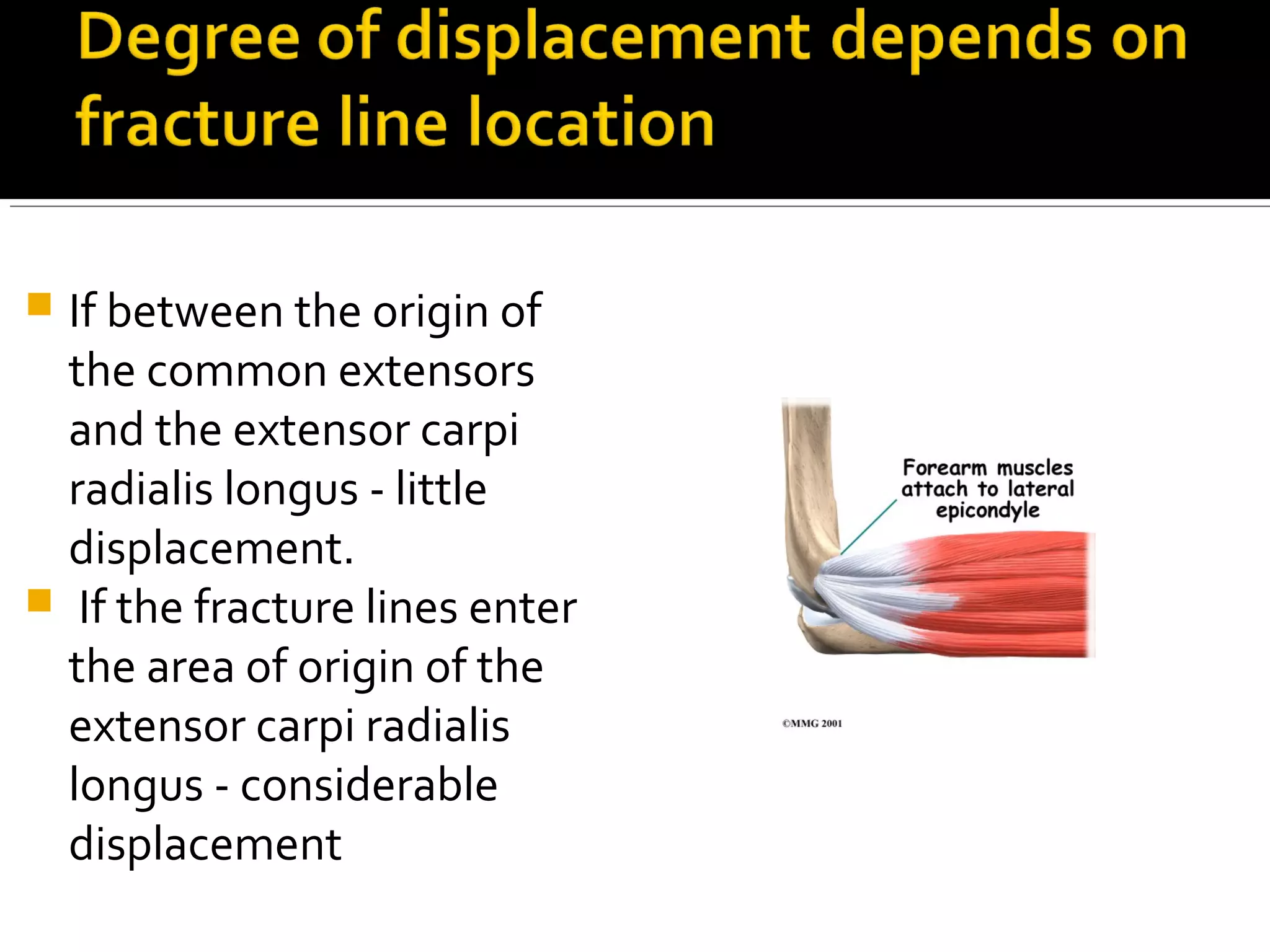 Apophyseal injuries of elbow , medial epicondyle avulsion fractures ...