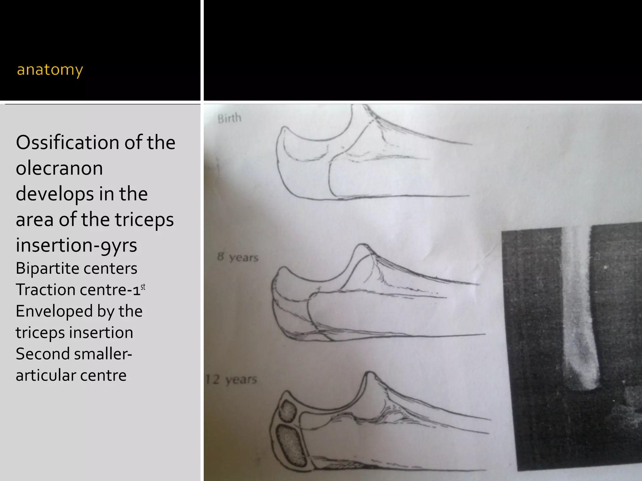 Apophyseal injuries of elbow , medial epicondyle avulsion fractures | PPT