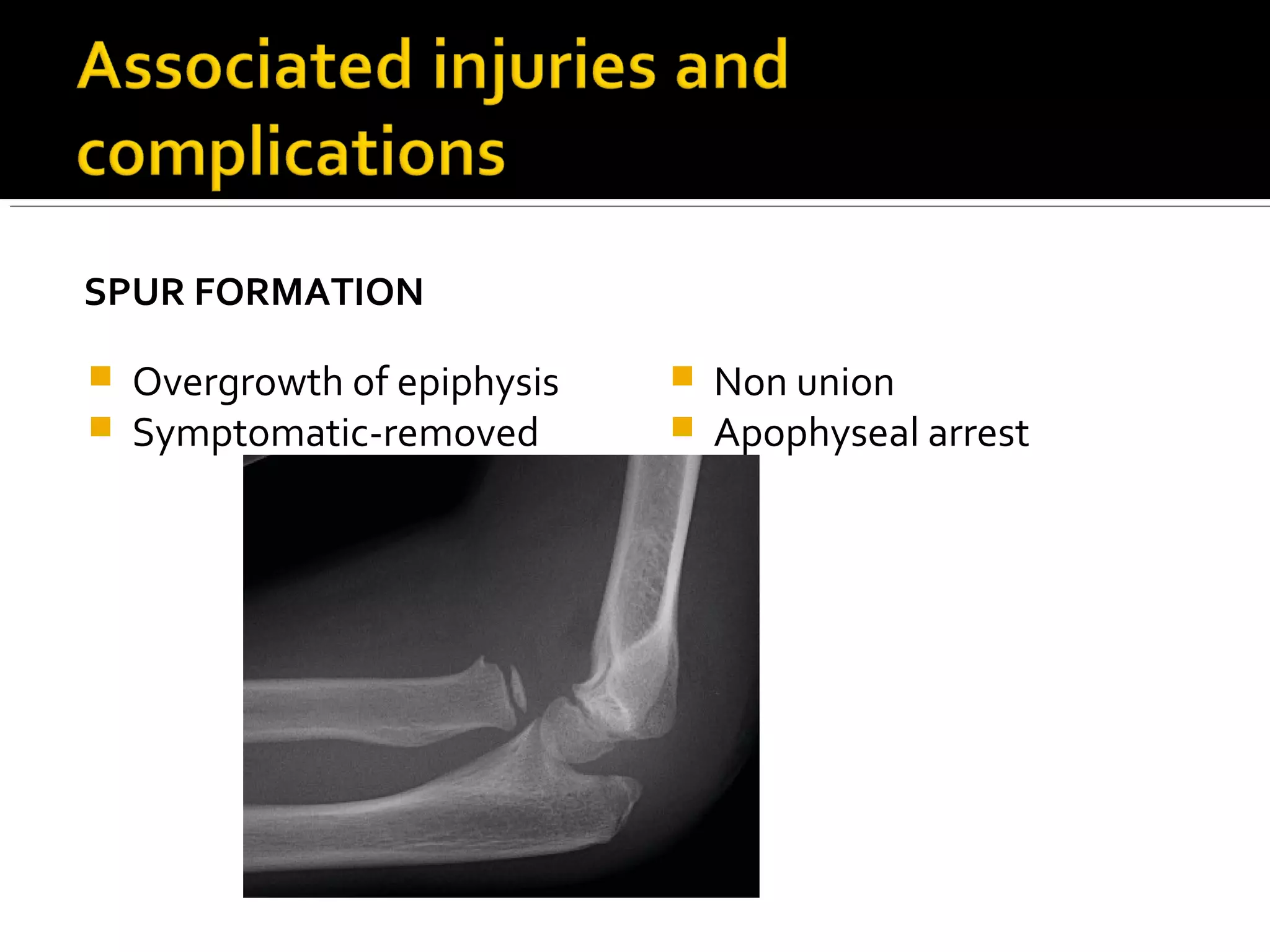 Apophyseal injuries of elbow , medial epicondyle avulsion fractures | PPT