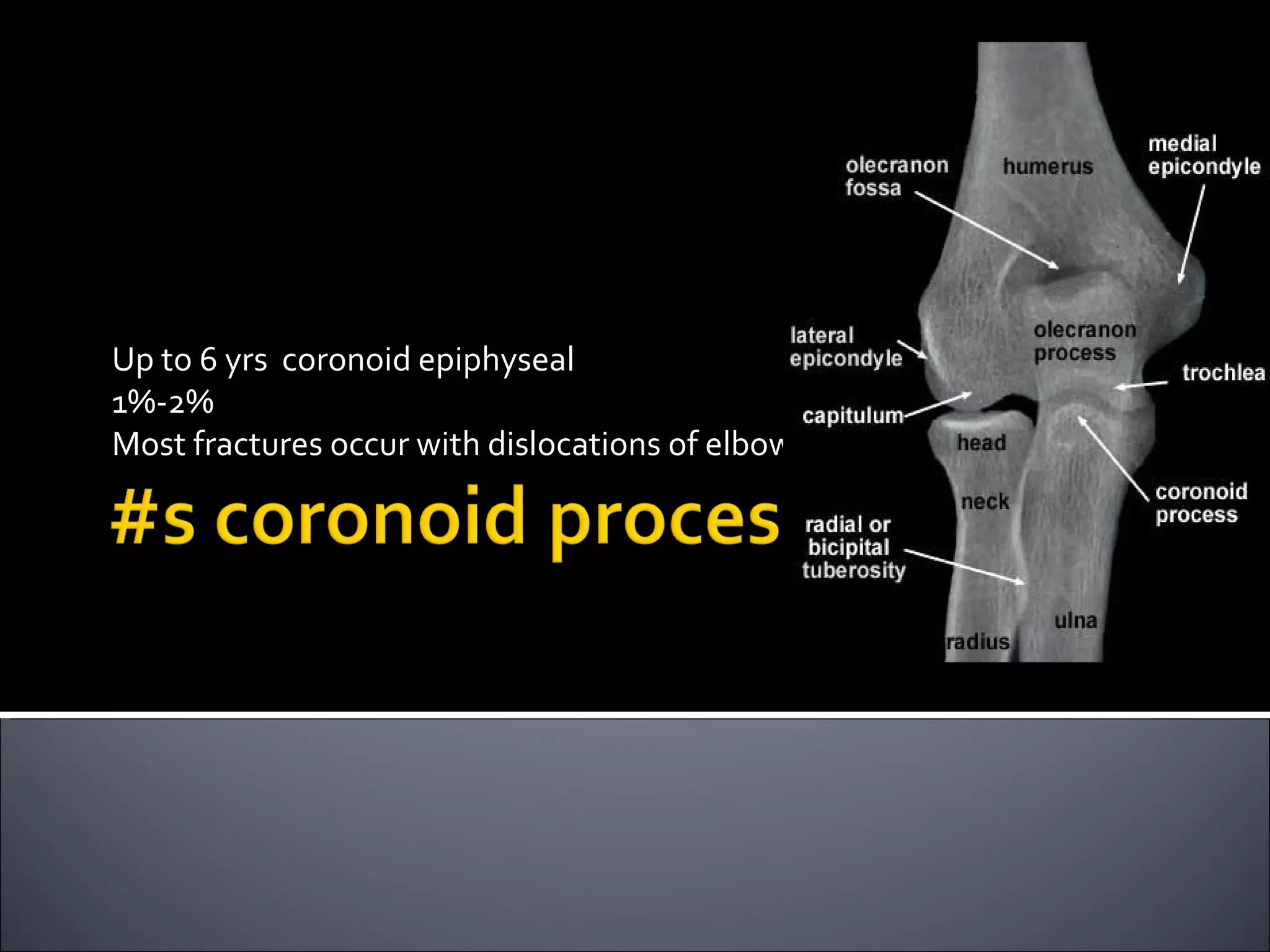 Apophyseal injuries of elbow , medial epicondyle avulsion fractures ...