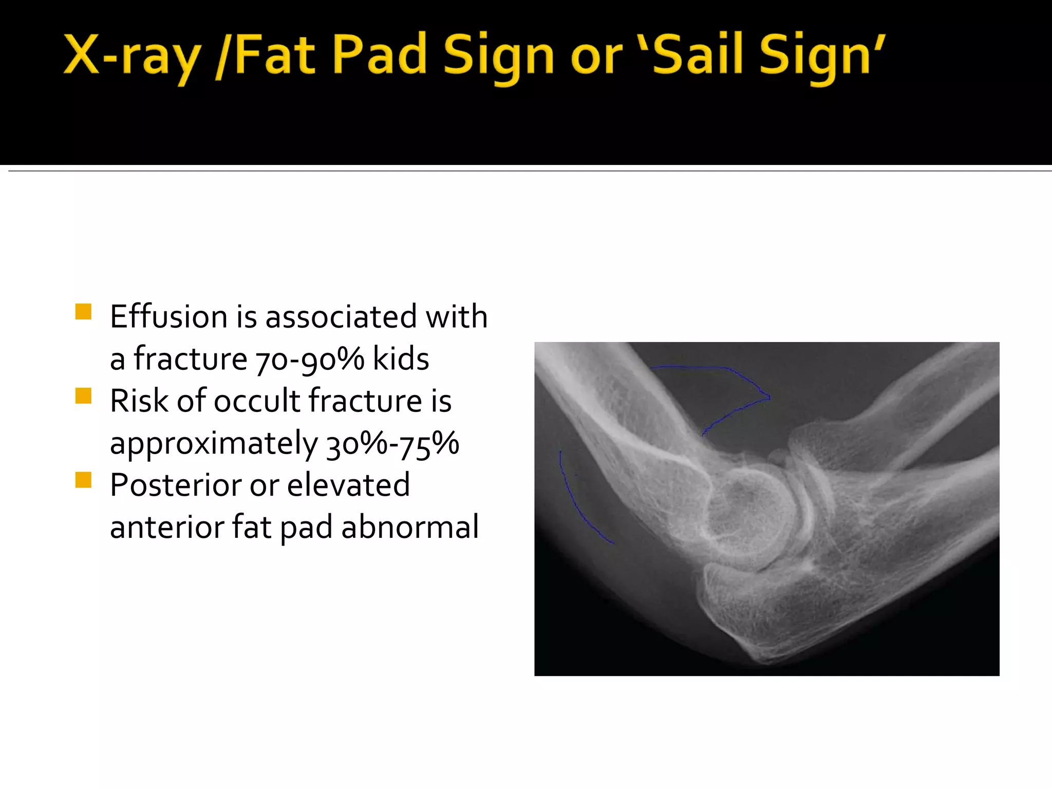 Apophyseal injuries of elbow , medial epicondyle avulsion fractures | PPT
