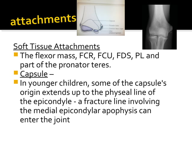 Apophyseal injuries of elbow , medial epicondyle avulsion fractures ...
