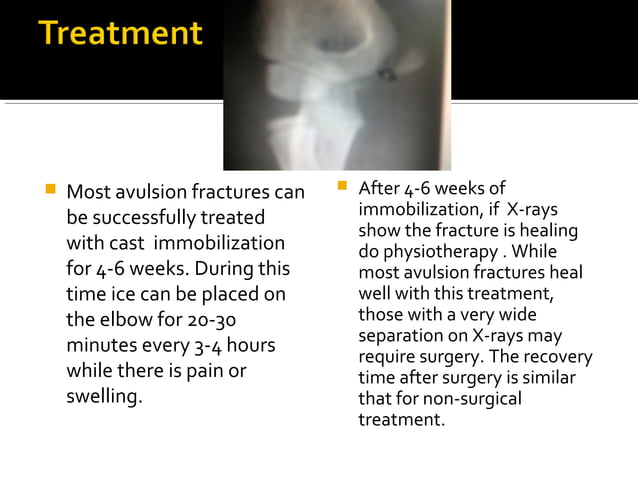 Apophyseal injuries of elbow , medial epicondyle avulsion fractures ...