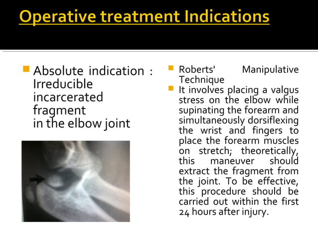 Apophyseal injuries of elbow , medial epicondyle avulsion fractures ...