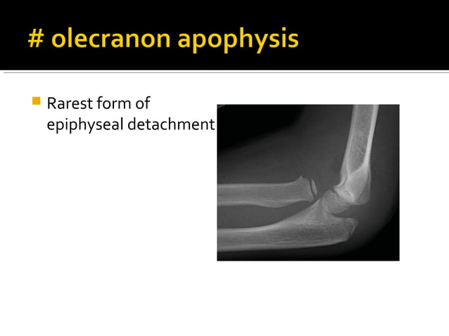 Apophyseal injuries of elbow , medial epicondyle avulsion fractures ...