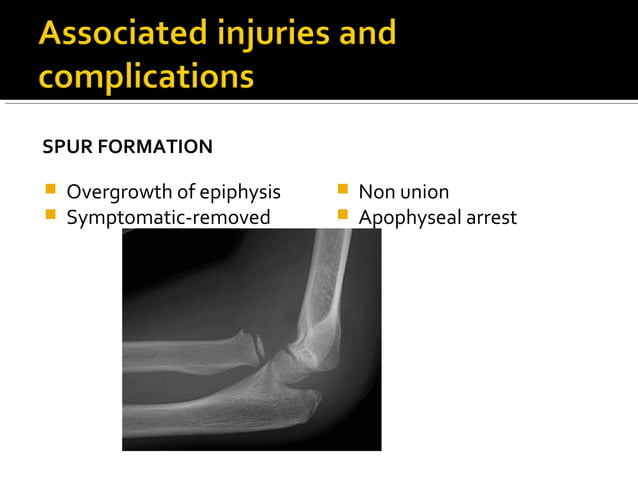 Apophyseal injuries of elbow , medial epicondyle avulsion fractures ...