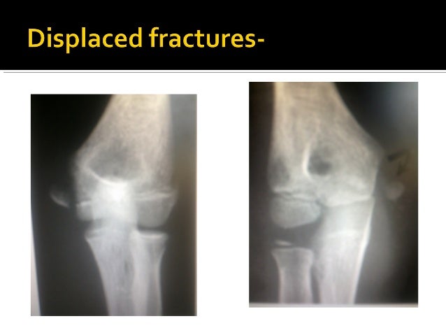 Apophyseal injuries of elbow , medial epicondyle avulsion fractures