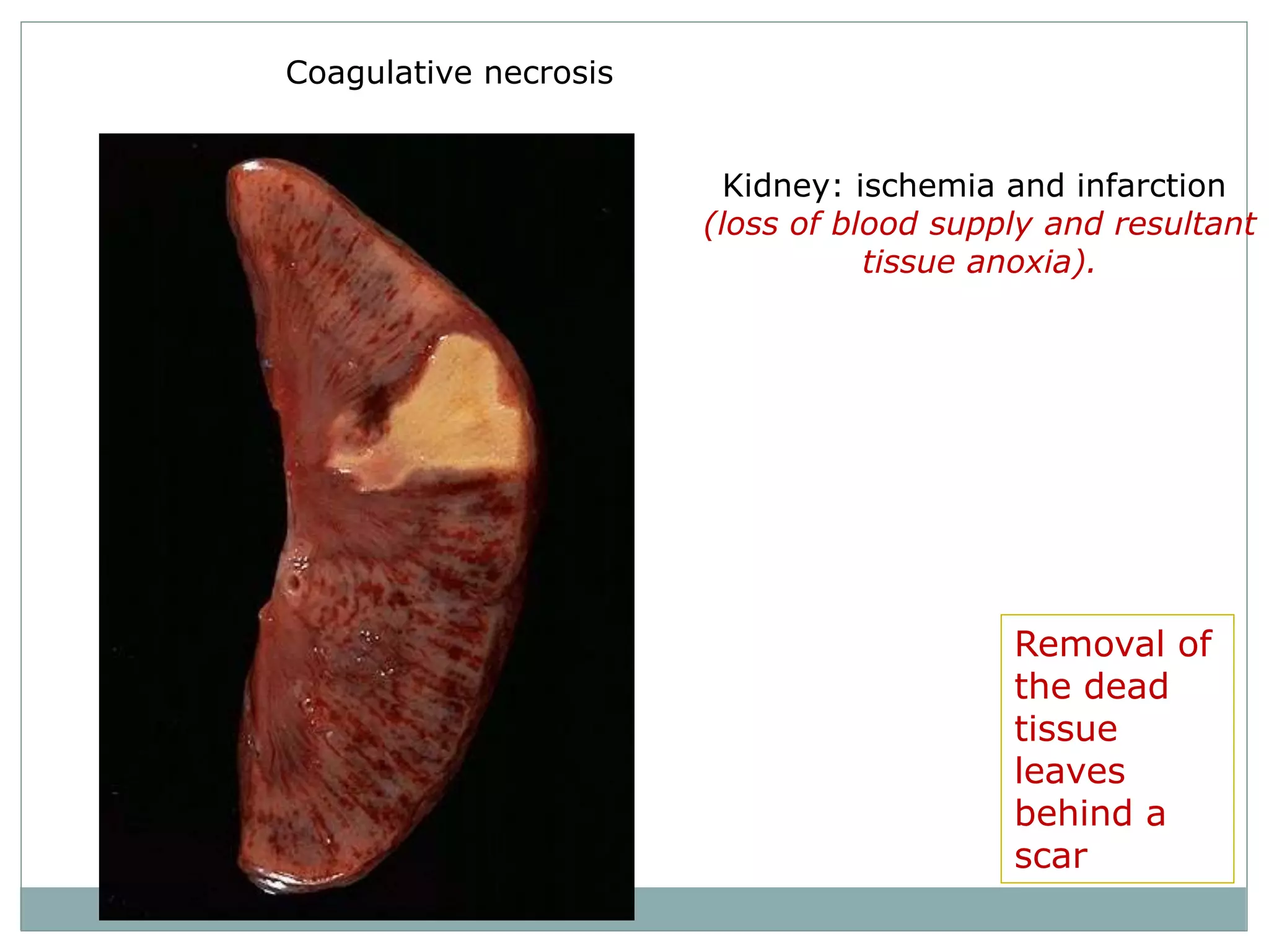 Apoptosis & nekrosis | PPTX
