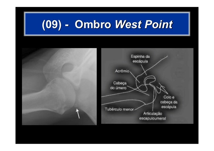 Apostila sobre a aula de incidências do ombro
