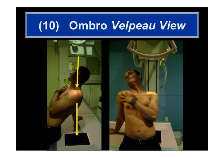 Velpeau View Xr – Radiological Assessment of the Shoulder – JYWIO