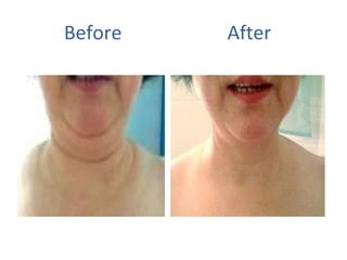 Many before and after photos showing the power of ageLOC technology | PPT