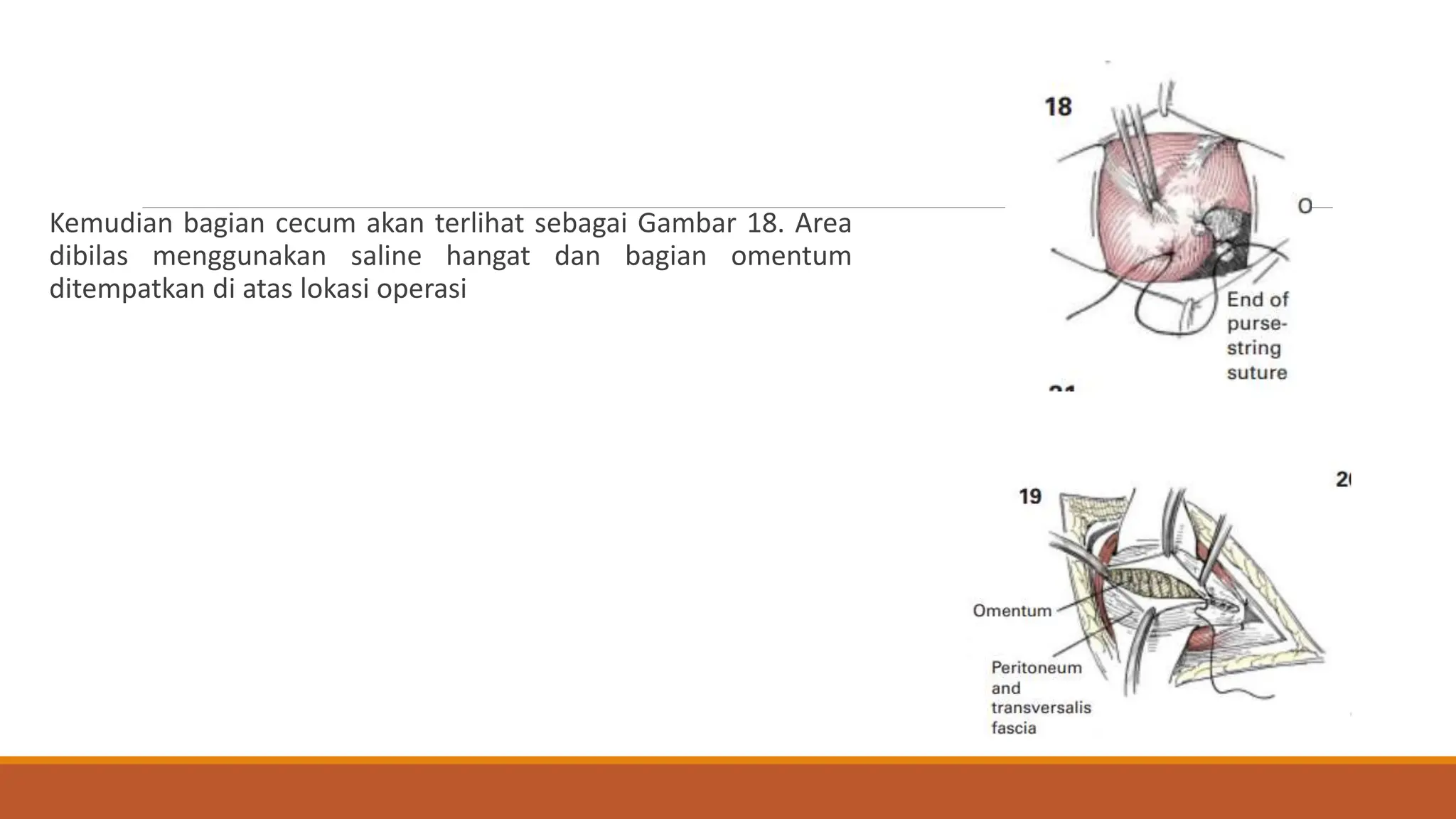Appendectomy - Teknik Operasi dan Persiapan | PPT