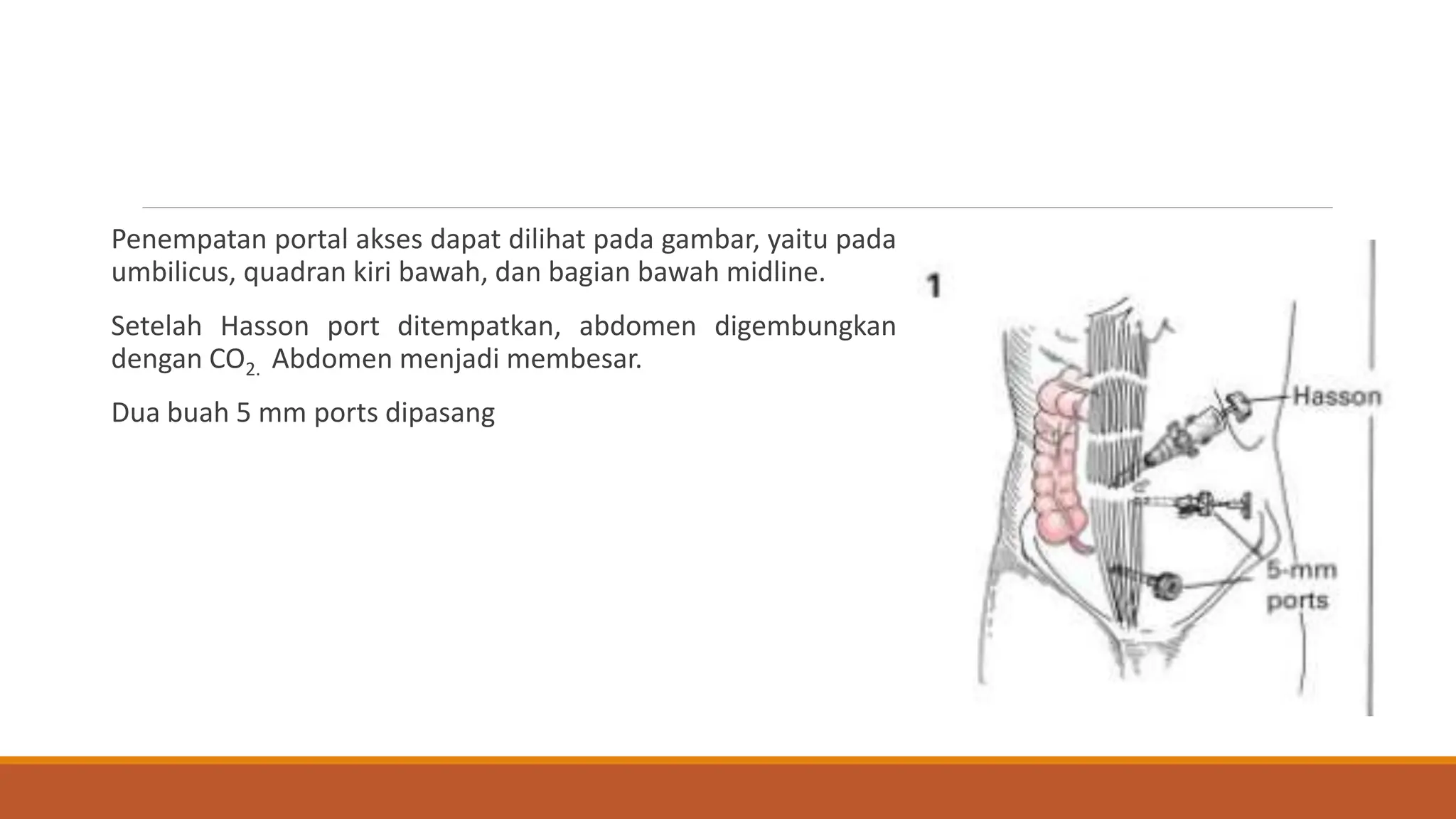 Appendectomy - Teknik Operasi dan Persiapan | PPT
