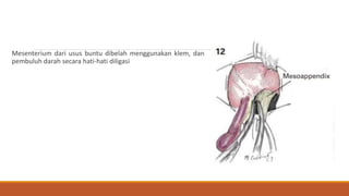 Appendectomy - Teknik Operasi dan Persiapan | PPT