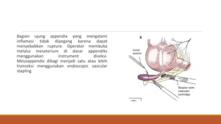 Appendectomy - Teknik Operasi dan Persiapan | PPT