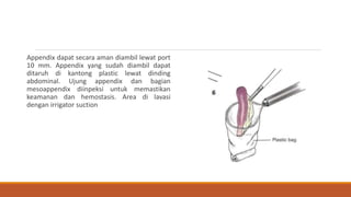 Appendectomy - Teknik Operasi dan Persiapan | PPT
