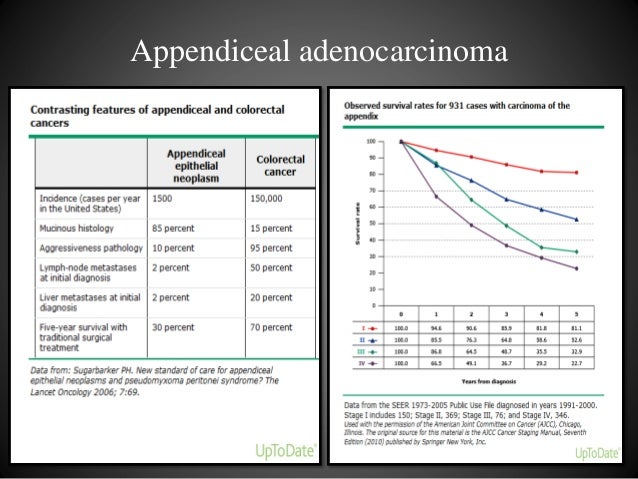 Appendiceal adenocarcinoma