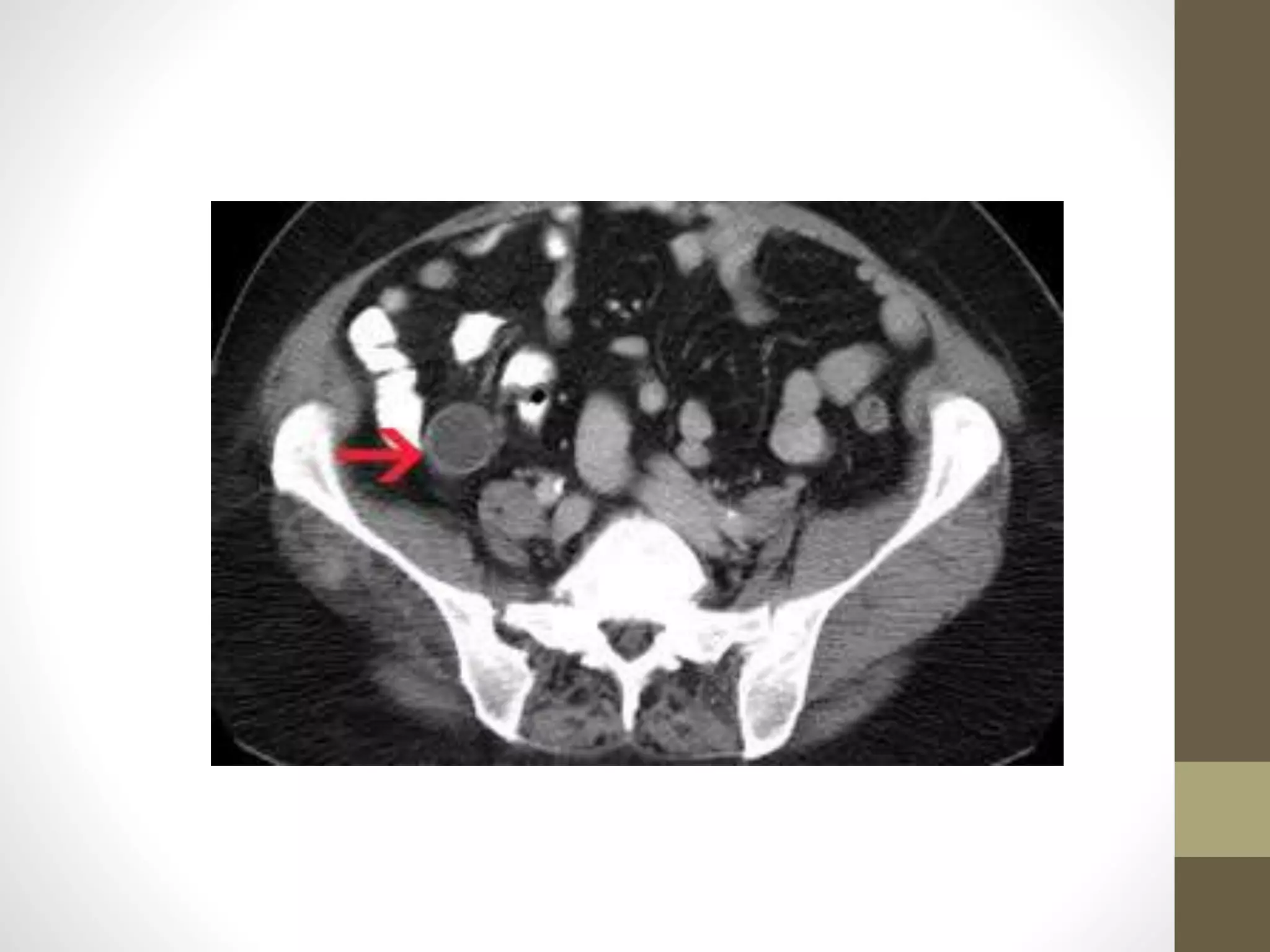 Appendiceal Mucocele.pptx