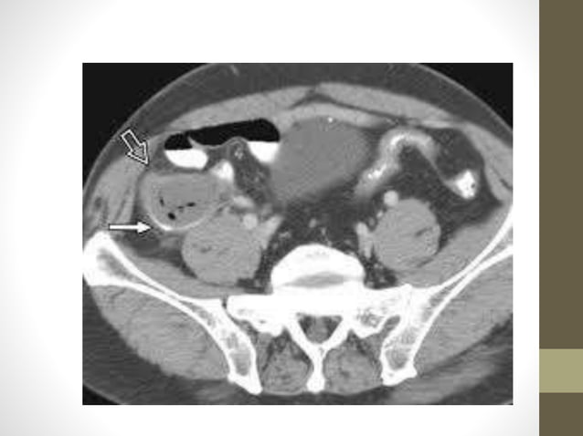 Appendiceal Mucocele.pptx