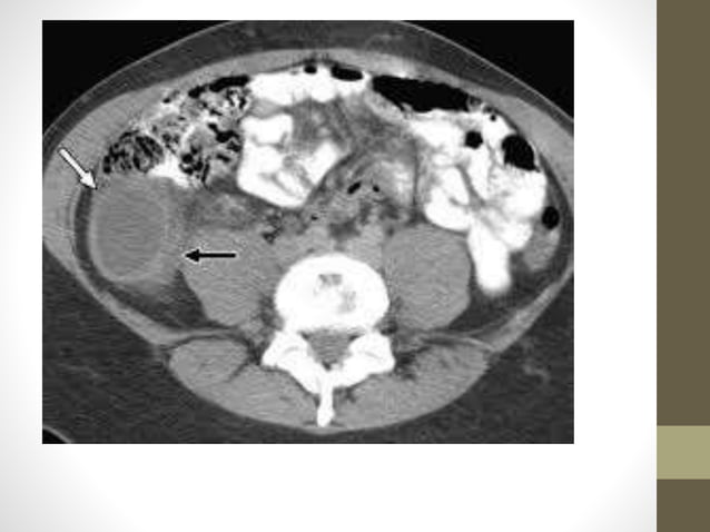 Appendiceal Mucocele.pptx