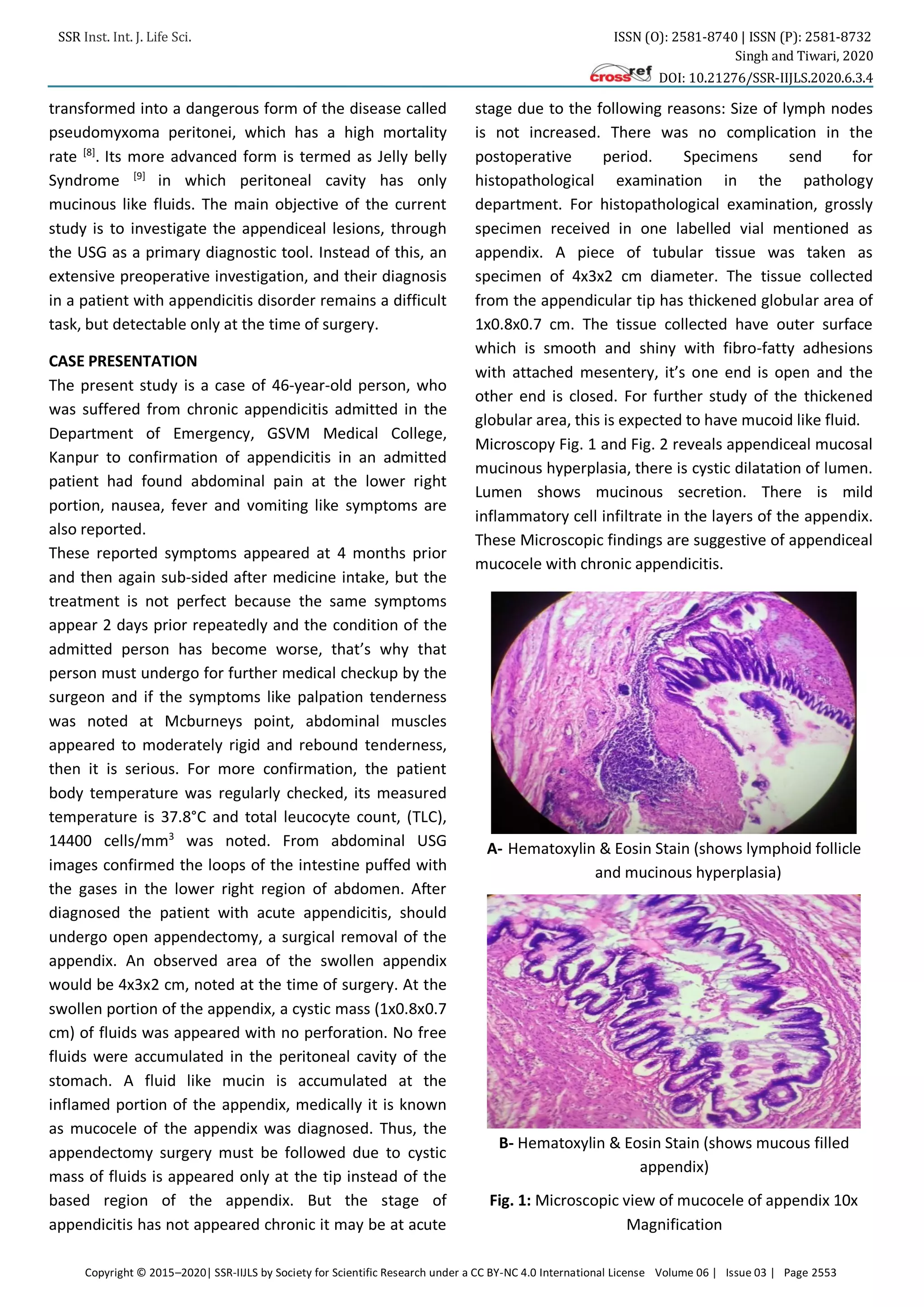 Appendiceal_Mucocele_Chronic_Appendicitis.pdf