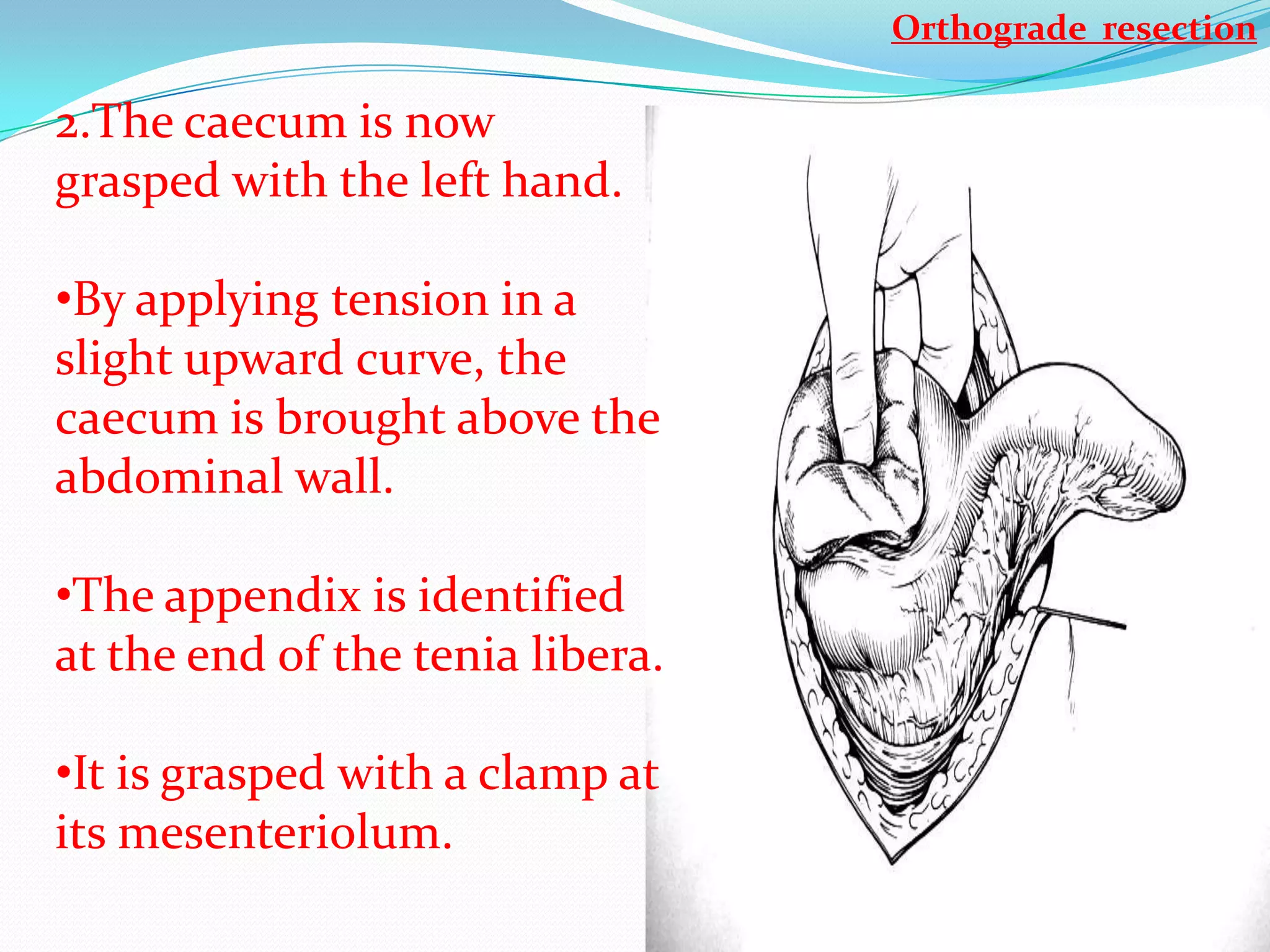 Appendicectomy | PPTX