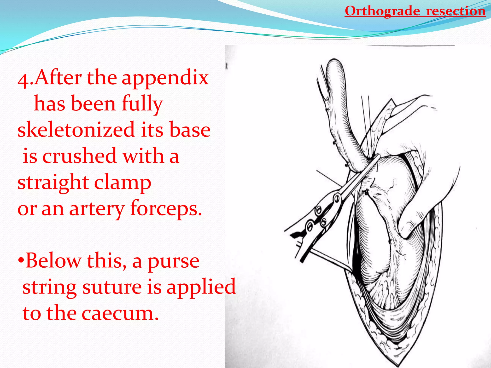 Appendicectomy | PPTX
