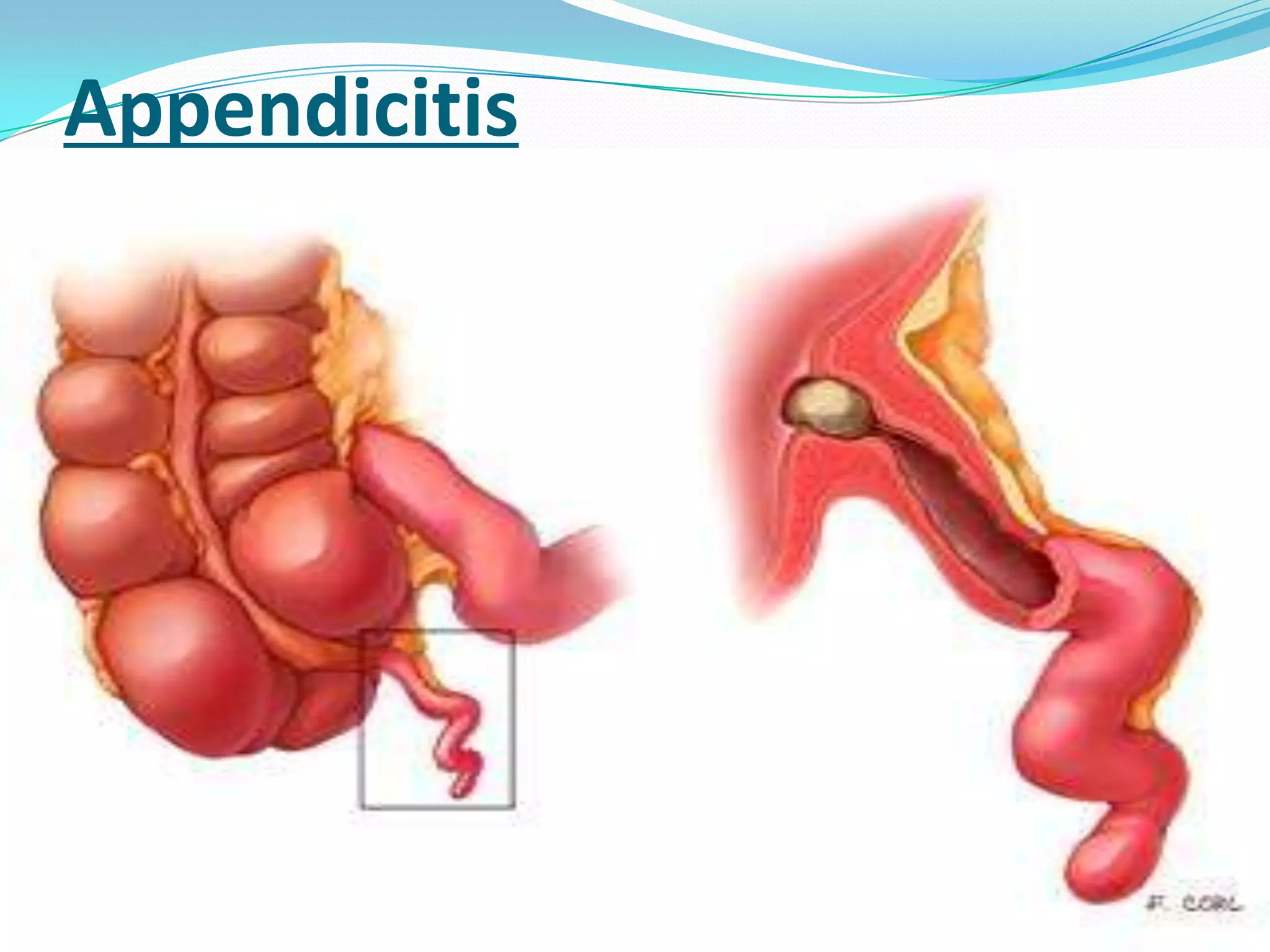 Appendicectomy Pptx