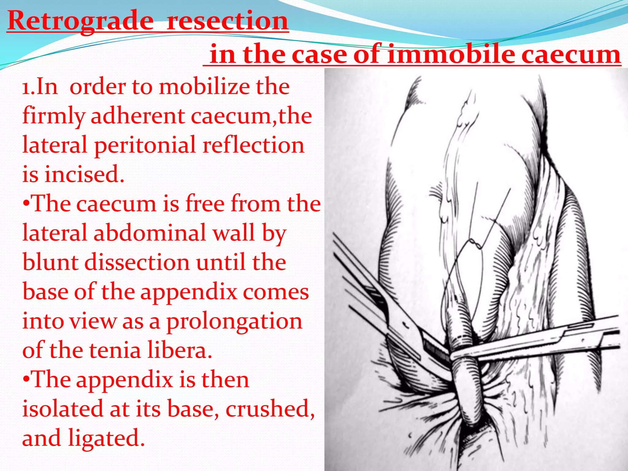 Appendicectomy | PPTX