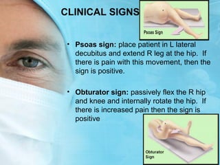 Appendicectomy | PPT