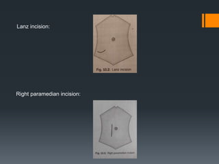 Appendicectomy | PPTX