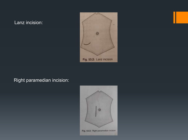 Appendicectomy | PPT