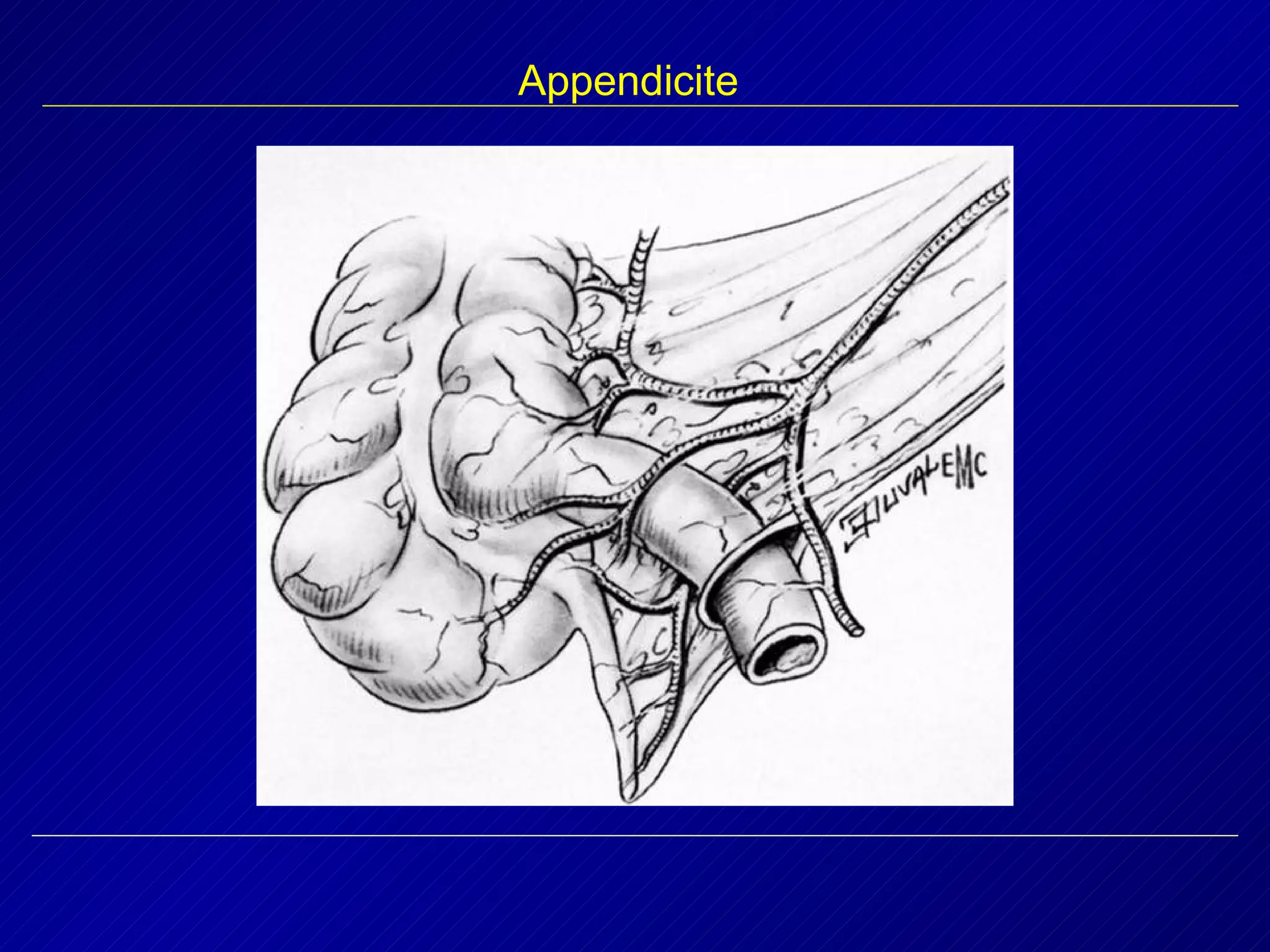 Appendicite | PPT